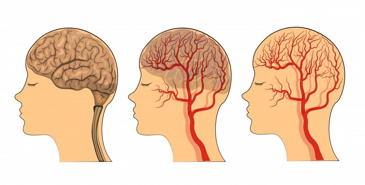 Vascular EDS Can Present with Atypical Headaches, Report Suggests